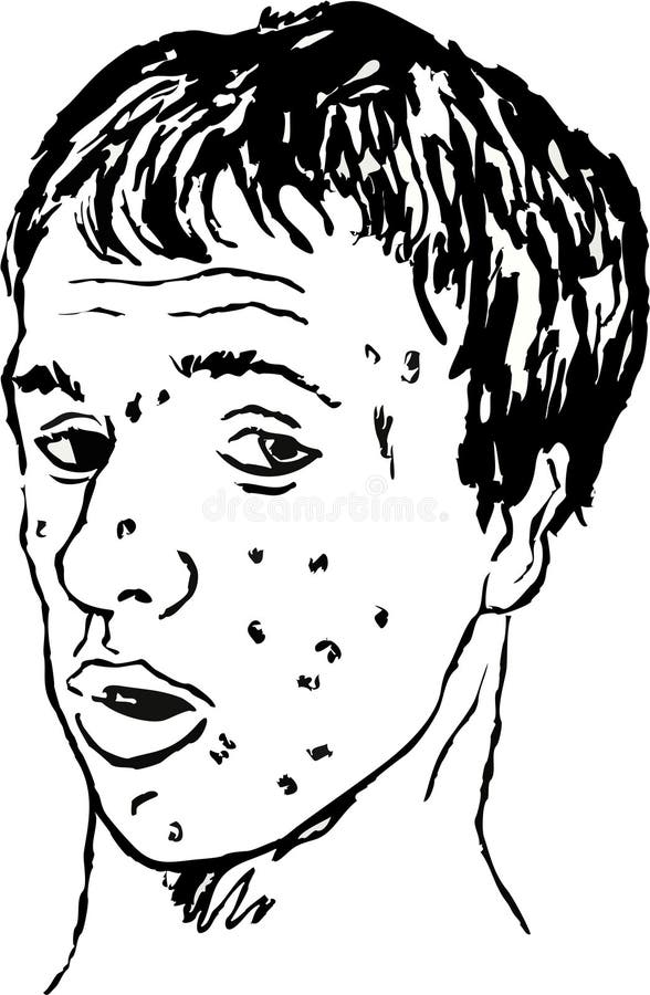 Spotty teenager stock illustration. Illustration of spotty - 1392581
