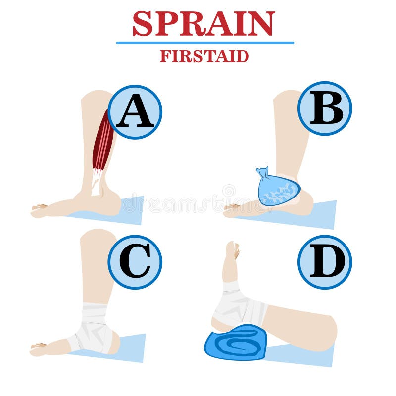 Sprain Stock Illustrations – 4,906 Sprain Stock Illustrations, Vectors ...