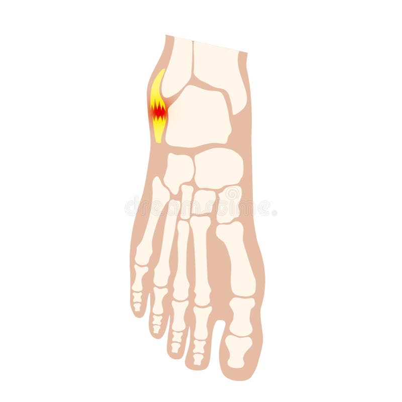 Sprained Ankle Stock Illustrations – 116 Sprained Ankle Stock ...