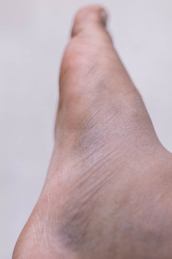 Sprained and Swollen Ankle. Ankle Injury with Dislocation and Sprains ...