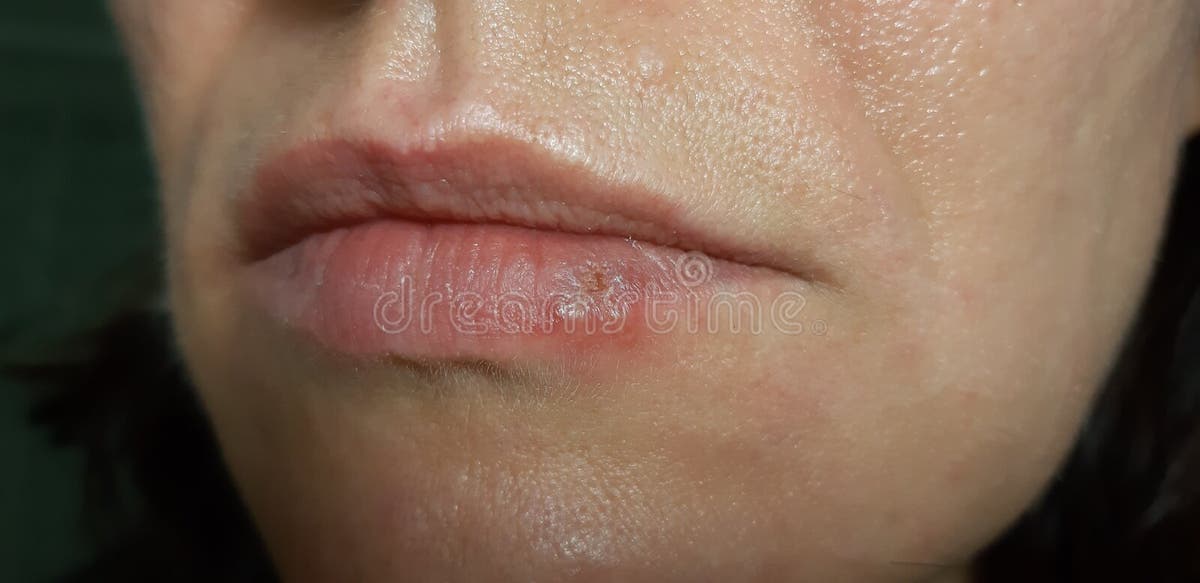 853 Herpes Simplex Stock Photos - Free & Royalty-Free Stock Photos from ...