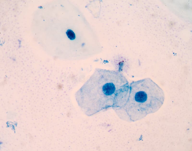 Squamous Cell Carcinoma of the Lung Stock Photo - Image of tissue ...