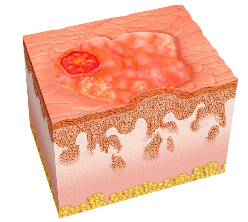 Squamous cell carcinoma stock illustration. Illustration of trunk ...