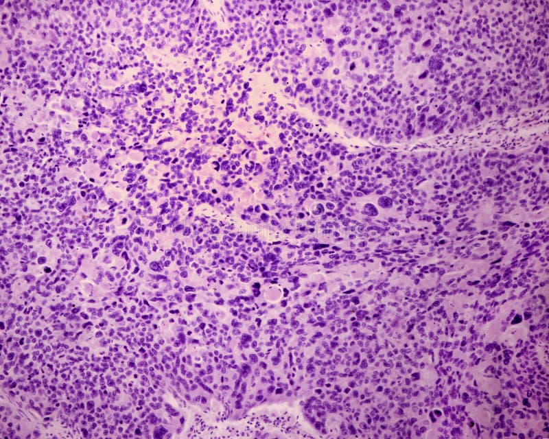 Cell Atypia Stock Photos - Free & Royalty-Free Stock Photos from Dreamstime