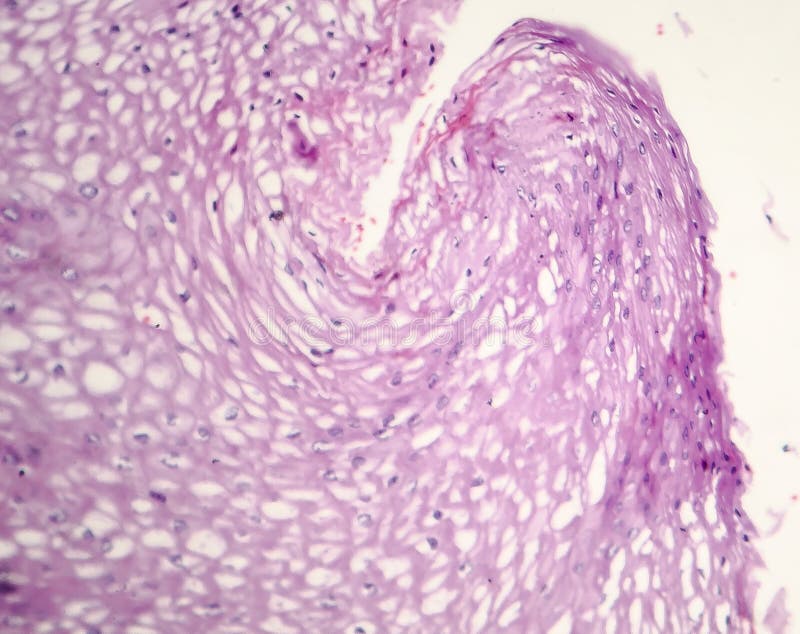 Squamous Cell Carcinoma