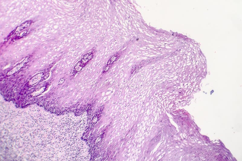 Squamous cell carcinoma stock image. Image of cancer - 122939377