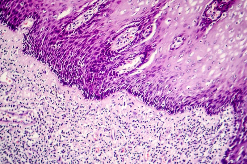 Squamous cell carcinoma stock image. Image of epithelial - 122939641