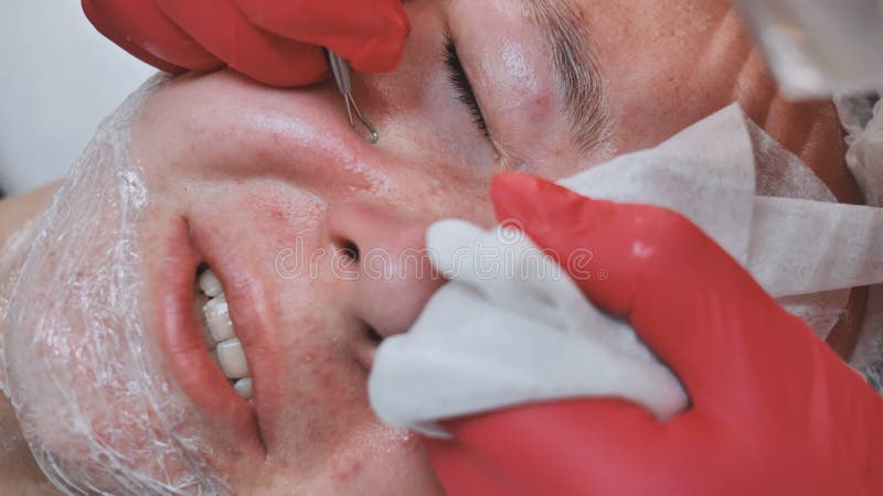Squeezing Acne from a Girl with Problem Skin in the Salon Using a Loop ...