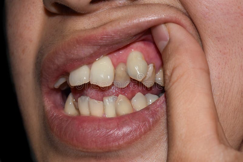 Stacked or Overlapping Canine Teeth of Asian Man. Also Called Crowded ...