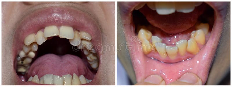 Stacked or Overlapping Teeth of Asian Man. Also Called Crowded Teeth ...