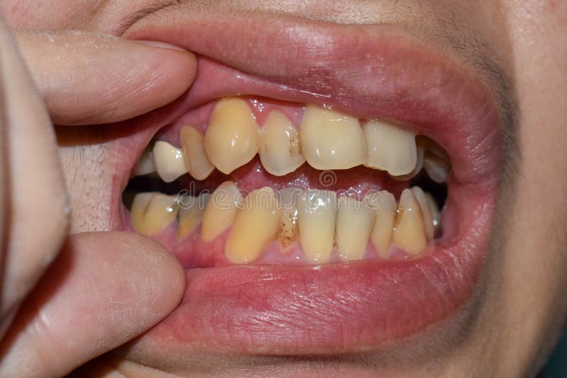 Stacked or Overlapping Teeth with Yellow Stain. Also Called Crowded ...