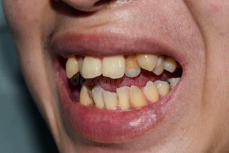 Stacked or Overlapping Teeth with Yellow Stain. Also Called Crowded ...