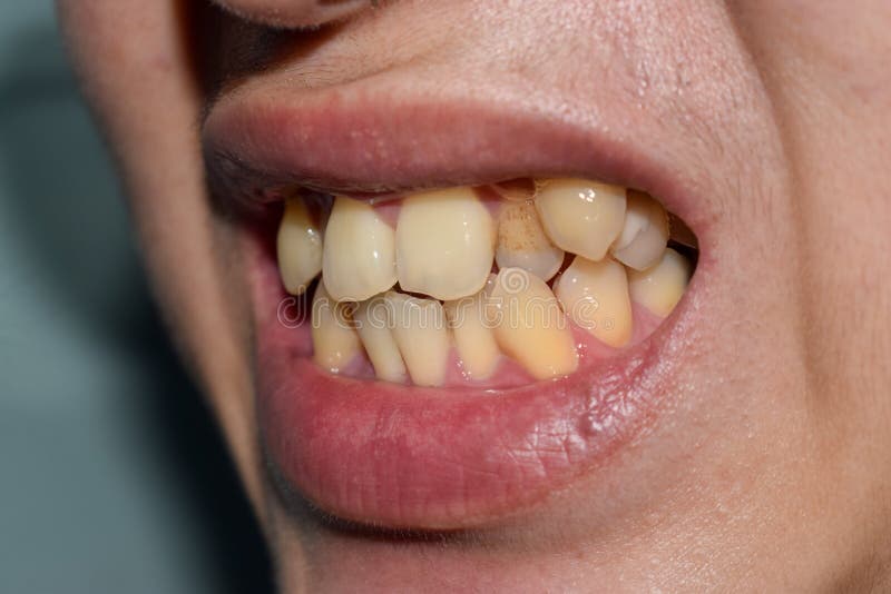 Stacked or Overlapping Teeth with Yellow Stain. Also Called Crowded ...