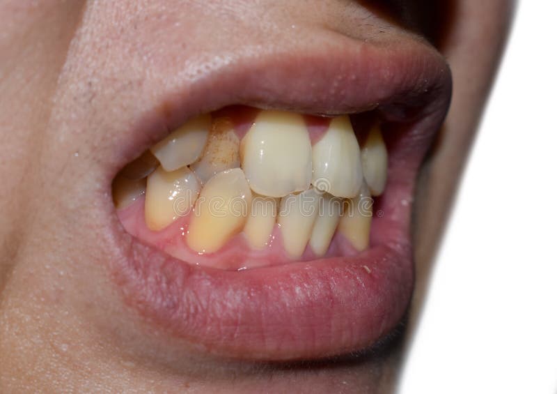 Stacked or Overlapping Teeth with Yellow Stain. Also Called Crowded ...