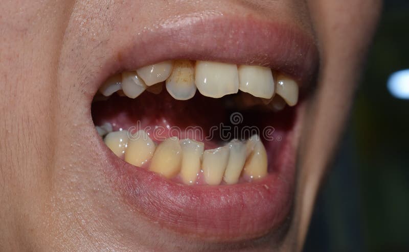 Stacked or Overlapping Teeth with Yellow Stain. Also Called Crowded ...