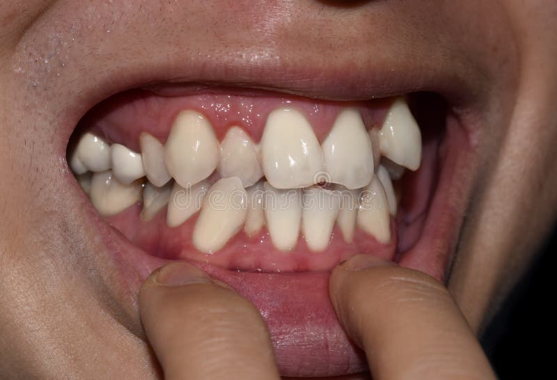 Stacked or Overlapping White Teeth. Also Called Crowded Teeth Stock ...