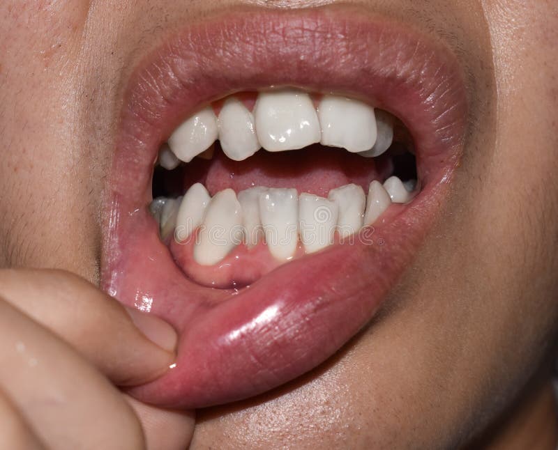 Stacked or Overlapping White Teeth. Also Called Crowded Teeth Stock ...