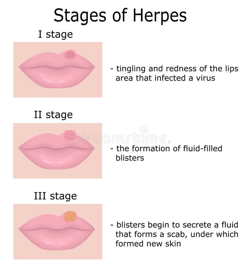 Herpes Stock Illustrationen, Vektoren, & Kliparts - 3,513 Stock ...