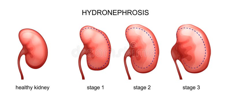 The Stage of Hydronephrosis Stock Vector - Illustration of health ...