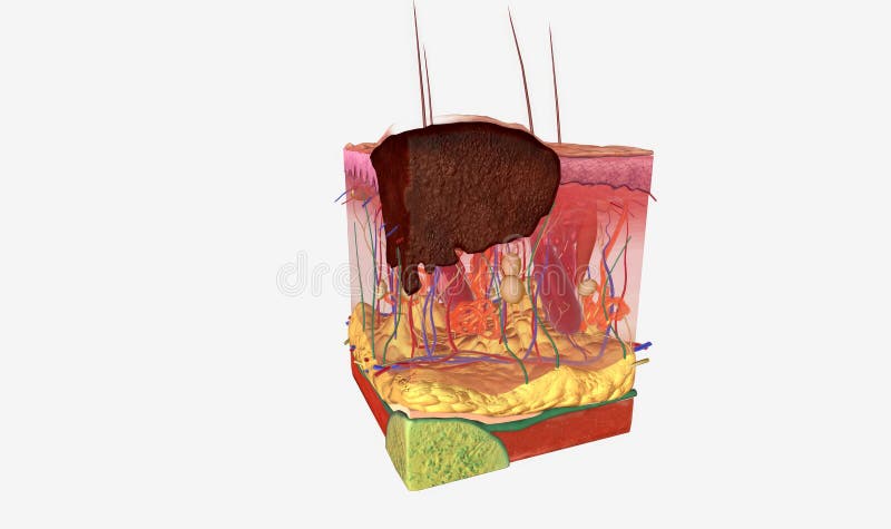 Stage I Melanoma Tumors Have Spread Out of the Epidermis and into the ... Stage I Melanoma Tumors Have Spread Out of the Epidermis and into the ...