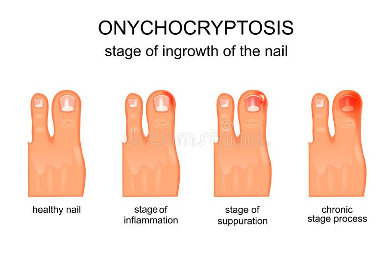 Stage of Ingrowth of the Nail Stock Vector - Illustration of ingrown ...