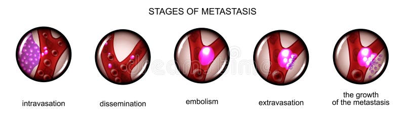Metastasis stock vector. Illustration of blood, science - 13570491