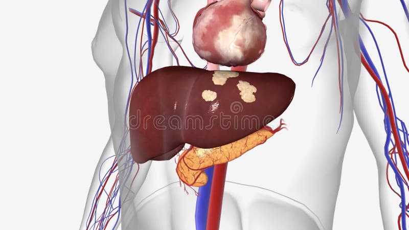 Pancreatic Cancer 3d Medical Illustration Stock Illustration ...