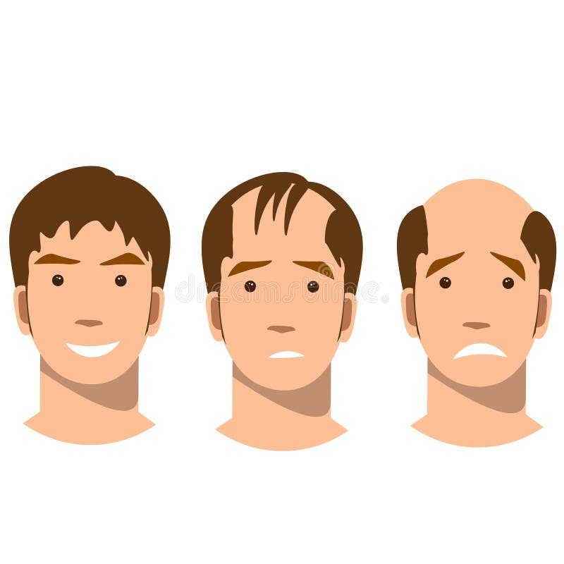 Stages of baldness. stock vector. Illustration of line - 94841885