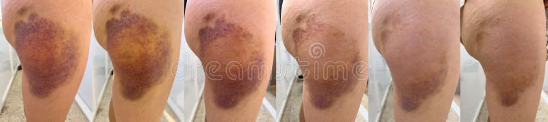 Bruise Stages Stock Photos - Free & Royalty-Free Stock Photos from ...