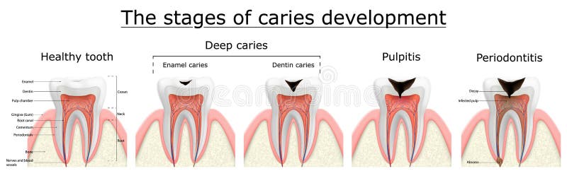 Stages of Caries Development. Dental Disease: Caries, Pulpitis and ...