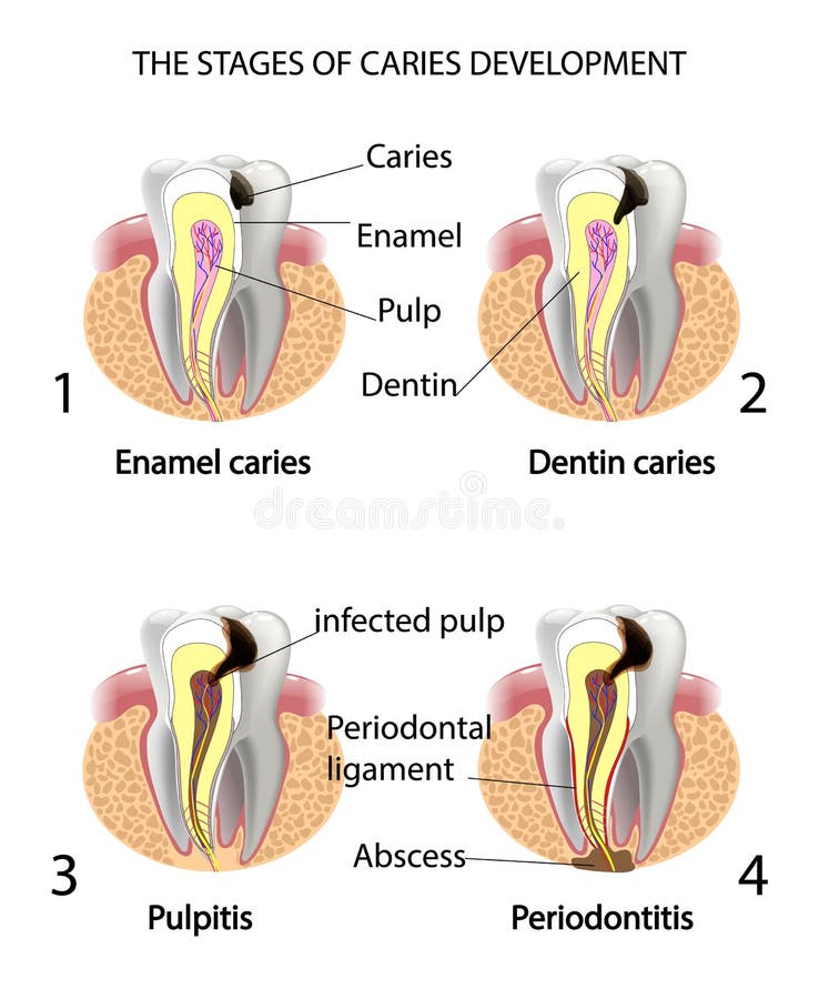 The Stages of Caries Development Stock Vector - Illustration of medical ...