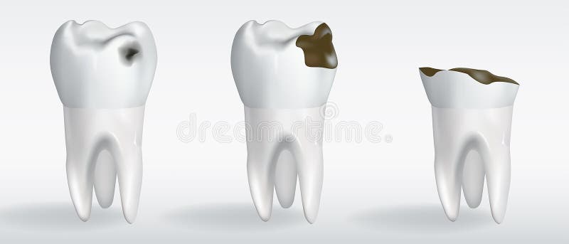 Caries Stages Infographics. Healthy Tooth, Enamel Caries, Dentin Caries ...