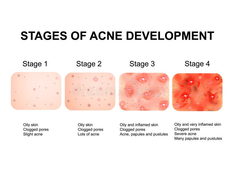 Stages of Development of Acne. Inflamed Skin with Scars, Acne and ...