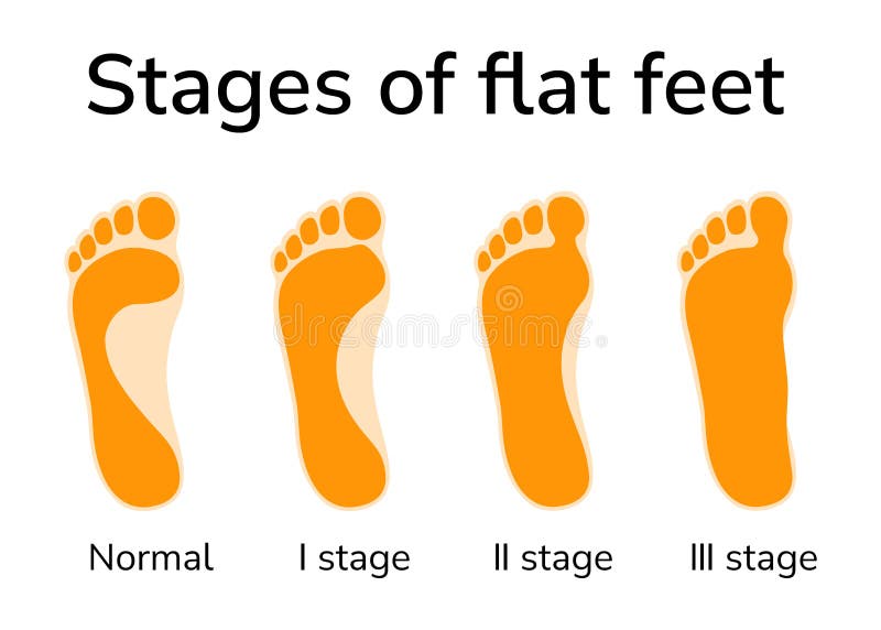 Stages of flat feet stock vector. Illustration of human - 243389978