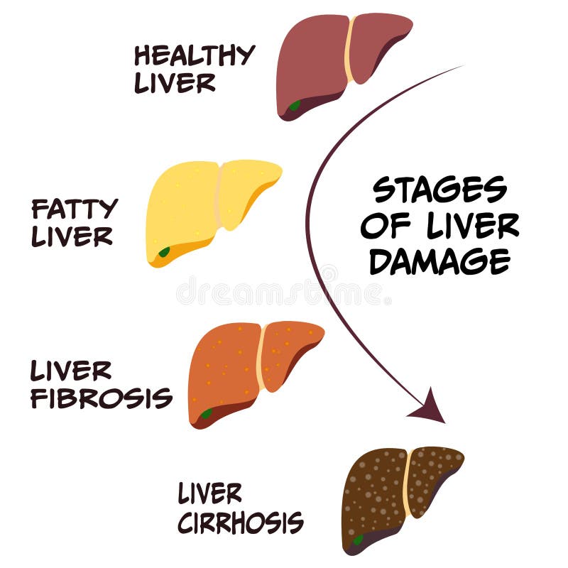 Stages of Liver Damage and Disease Stock Vector - Illustration of ...