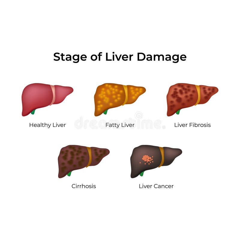 Stages of Liver Damage stock vector. Illustration of presentation ...