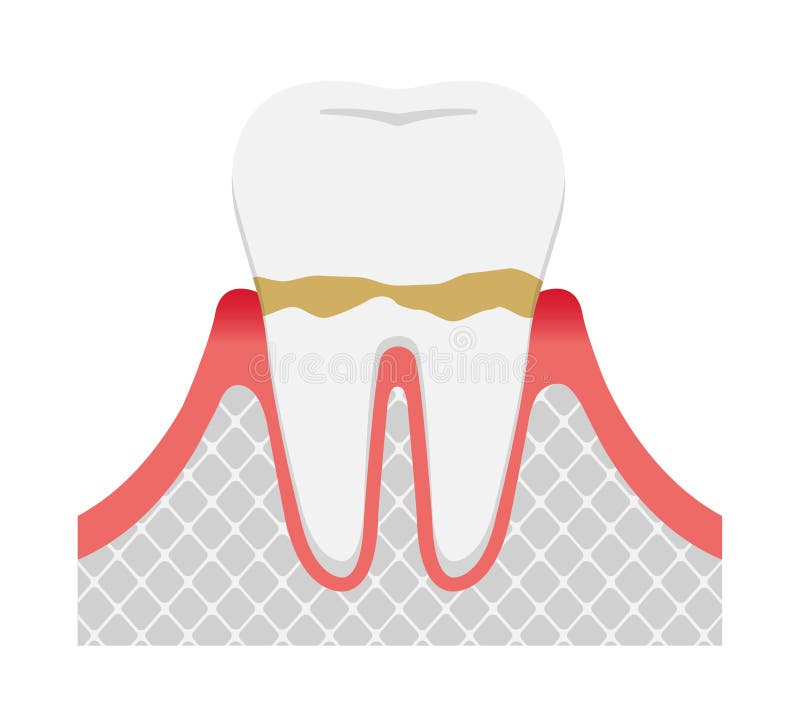 The Stages of Periodontitis Disease Illustration Stock Vector ... The Stages of Periodontitis Disease Illustration Stock Vector ...