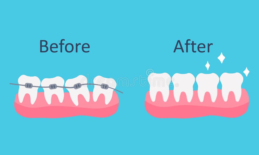 Stages of Teeth Alignment, before and after Correction with Brackets ...