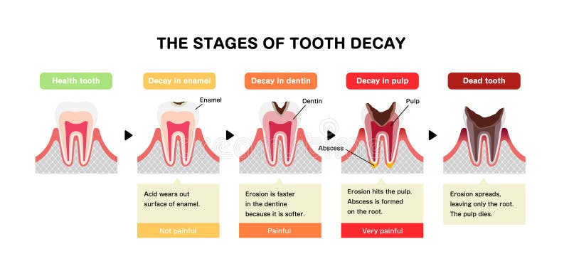 The Stages of Tooth Decay / Flat Vector Illustration Stock Vector ...