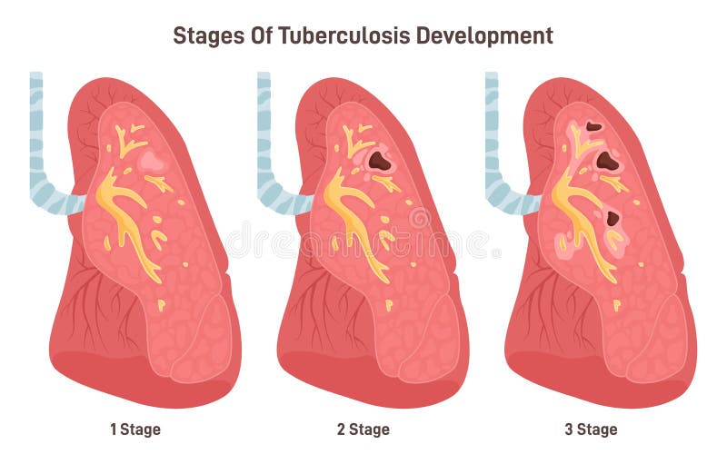 Stages of Tuberculosis Development. Respiratory System Disease. Human ...