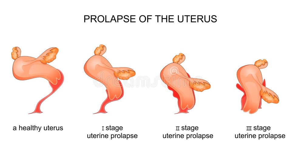Stages of uterine prolapse stock vector. Illustration of body - 93505069