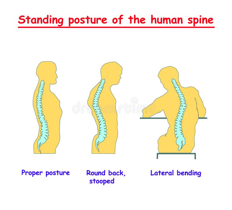 Standing Posture Of The Black Human Spine. Defects Of The Human Spine ...