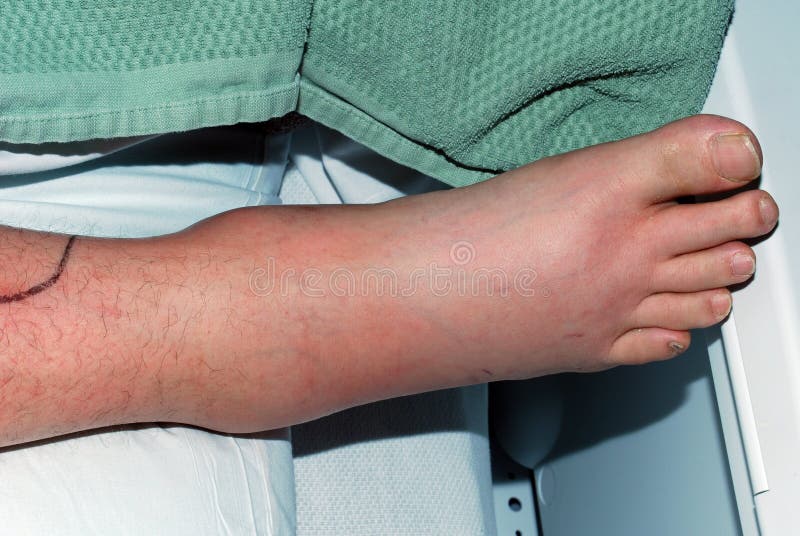 Staph Infecton stock image. Image of outline, sick, foot - 43953089