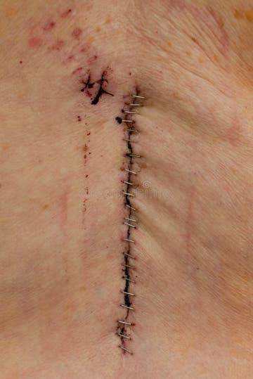 Staples after Spinal Fusion Surgery Stock Photo - Image of staple ...
