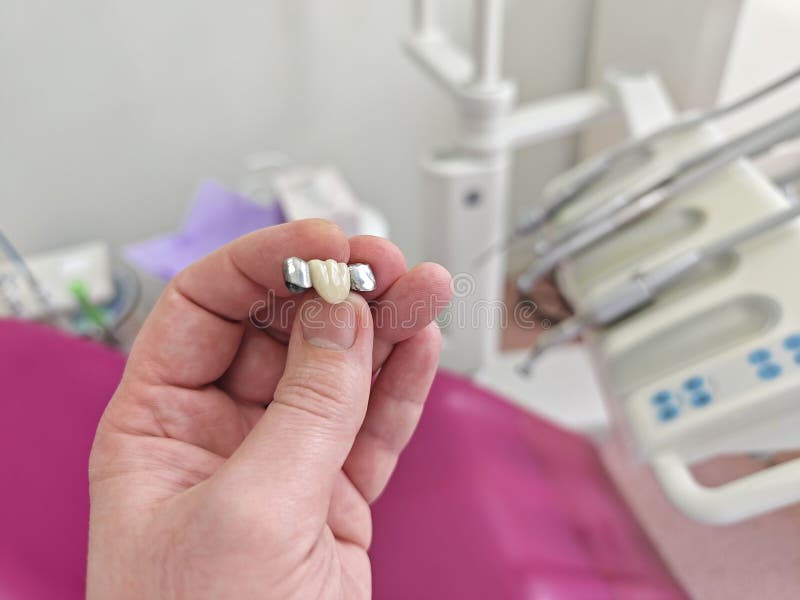 Steel Artificial Dental Crown for Dentition Restoration Stock Photo ...