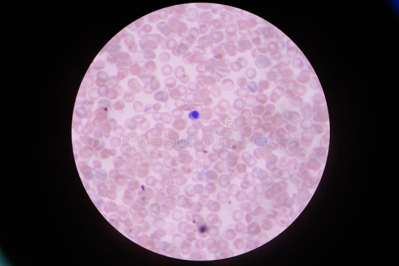 Nucleated Red Blood Cells NRC in Blood Smear Stock Photo - Image of ...
