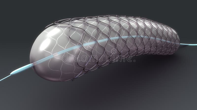 Brain Stent Stock Illustrations – 185 Brain Stent Stock Illustrations ...