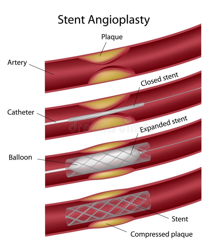 Stent Cardiovascular Stock Illustrations – 540 Stent Cardiovascular ...