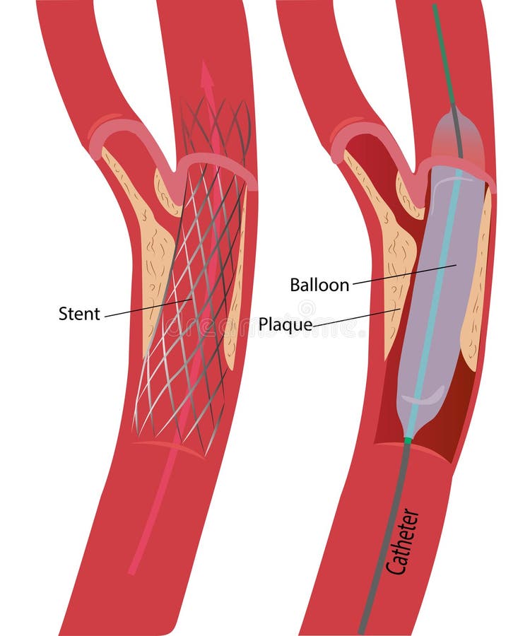 Stent for Balloon Angioplasty Stock Illustration - Illustration of ...