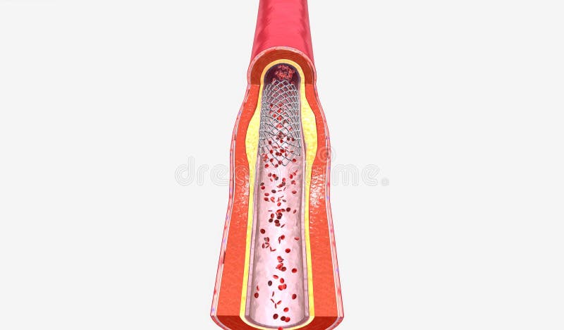 Stent Insertion into Artery Narrowed from Plaque Stock Illustration ...